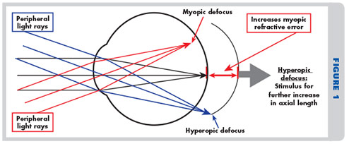 What's Happening to Our Vision? Peripheral Defocus and Myopia ...