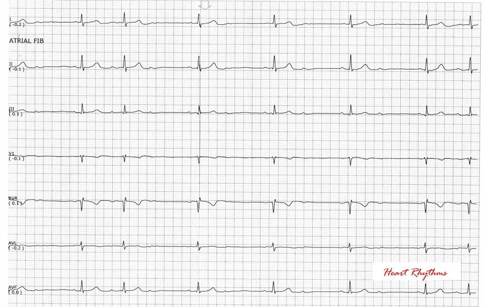 ECG Rhythms A 2 1 AV Block Is Not Right Away A Mobitz II ecg-rhythms-a-2-1-av-block-is-not-right-away-a-mobitz-ii