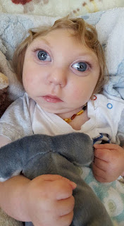 Cissas Blog: Baby born with half his skull missing beats all odds to ...