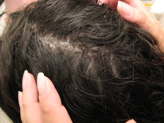 Healthy And Beauty Tips Treatment For Lice Lice Removal