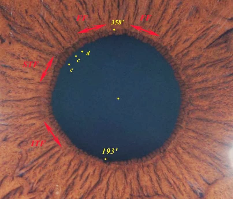 Modern & Multidimensional Iridology: IPB, Pupil, Pupillary Zone ...