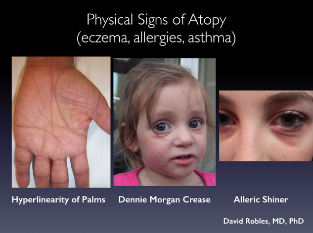 Atopic dermatitis (aka eczema): By David Robles, MD, PhD