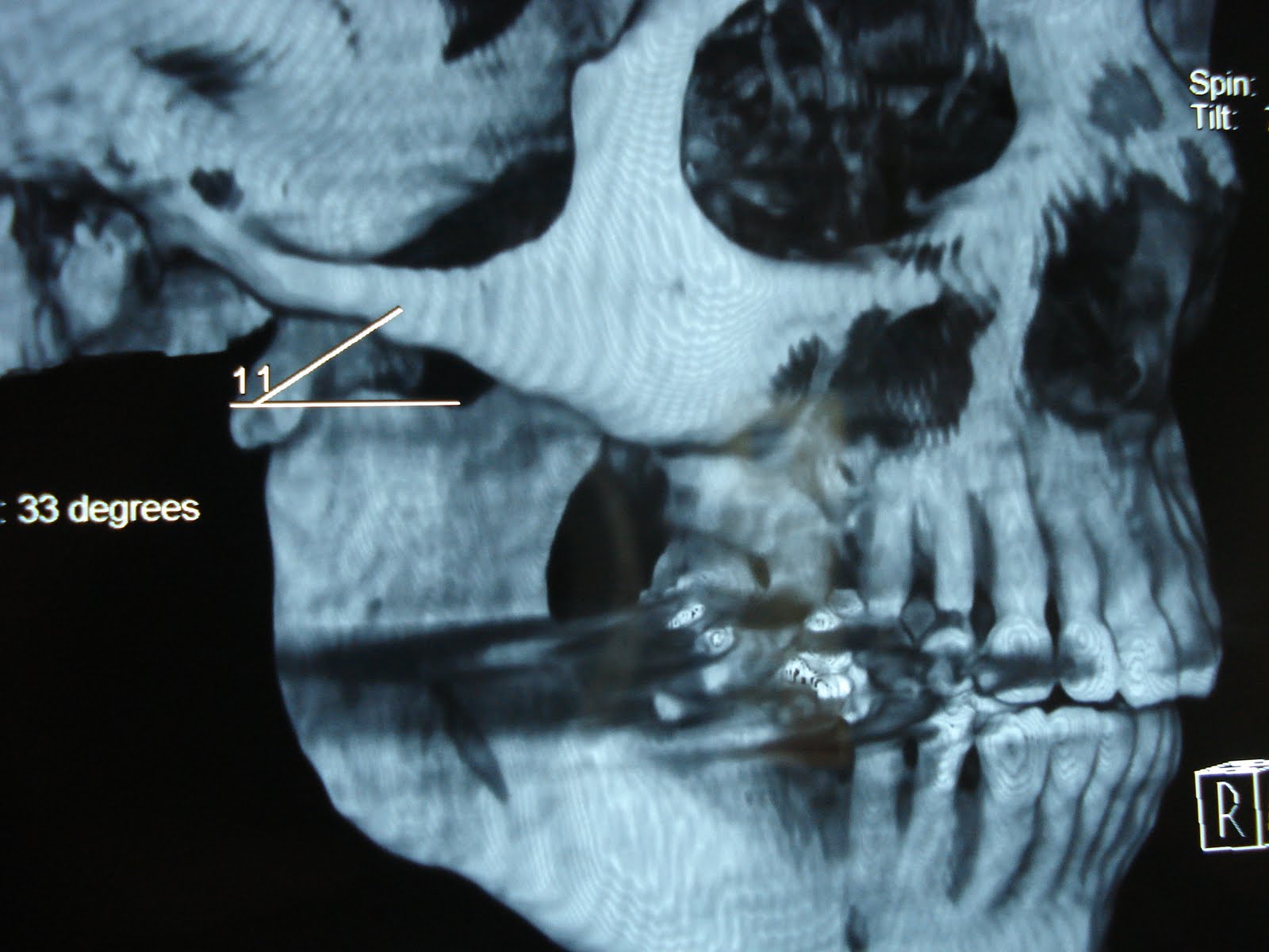 Dr. Miguel Angel Marroquin: FRACTURA DE CONDILO MANDIBULAR