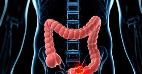 Gejala Kanker Usus Besar Stadium Awal ~ Obat Tumor Jinak Di Leher