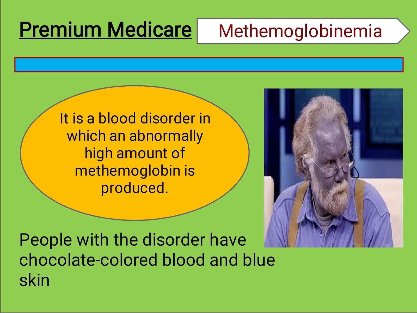 Methemoglobinemia - an overview | Argyria