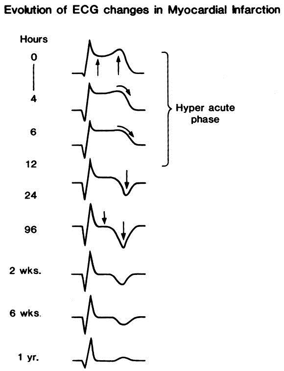 AMI (Acute Myocardial Infarc) ~ Medicomz Indonesian Medical RPG