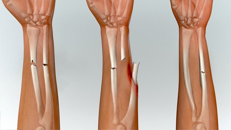 PENGOBATAN PATAH TULANG: PATAH TULANG