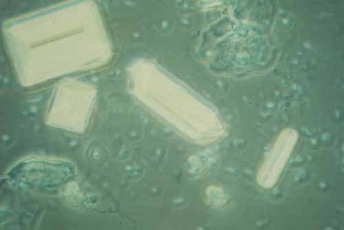 Atlas of Crystals found in alkaline urine | Free Medical Atlas