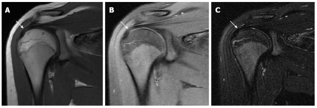 MRI Musculo-Skeletal Section: Full thickness tear