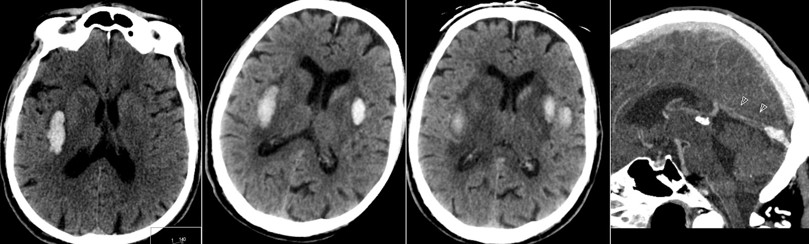 Radiology MRI: Deep Cerebral Venous Sinus Thrombosis with External ...