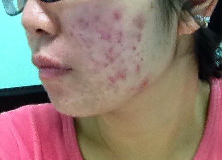 Colour my sun.: Acne Horror