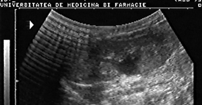 ecografie imagini medicina renal Renal nativ Hidronefroza | Terapii ...