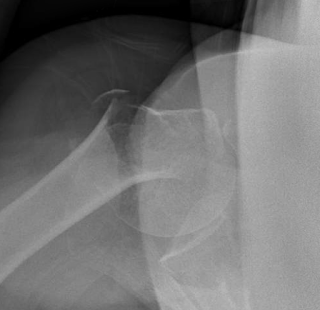 Shoulder and Elbow Surgery: Shoulder subluxation after proximal humerus ...