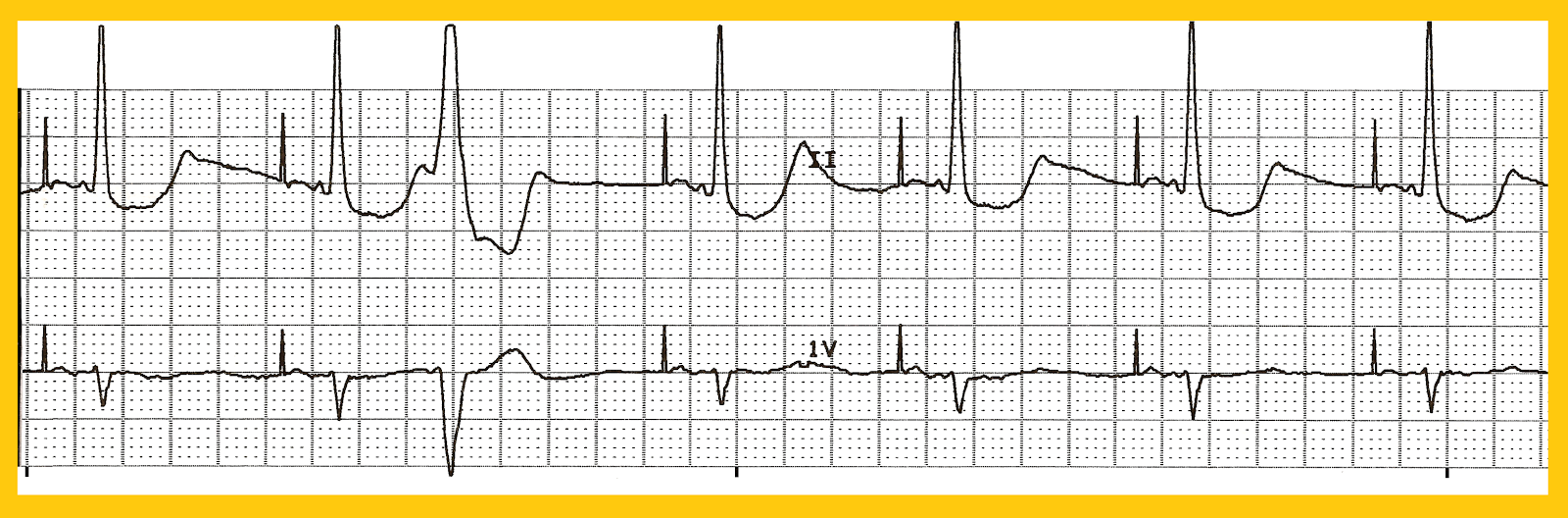 Practice EKG Strips 367