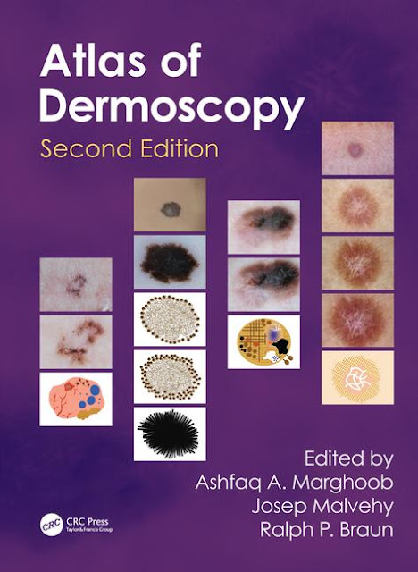 Atlas of Dermoscopy, Second Edition - Medical Yukti