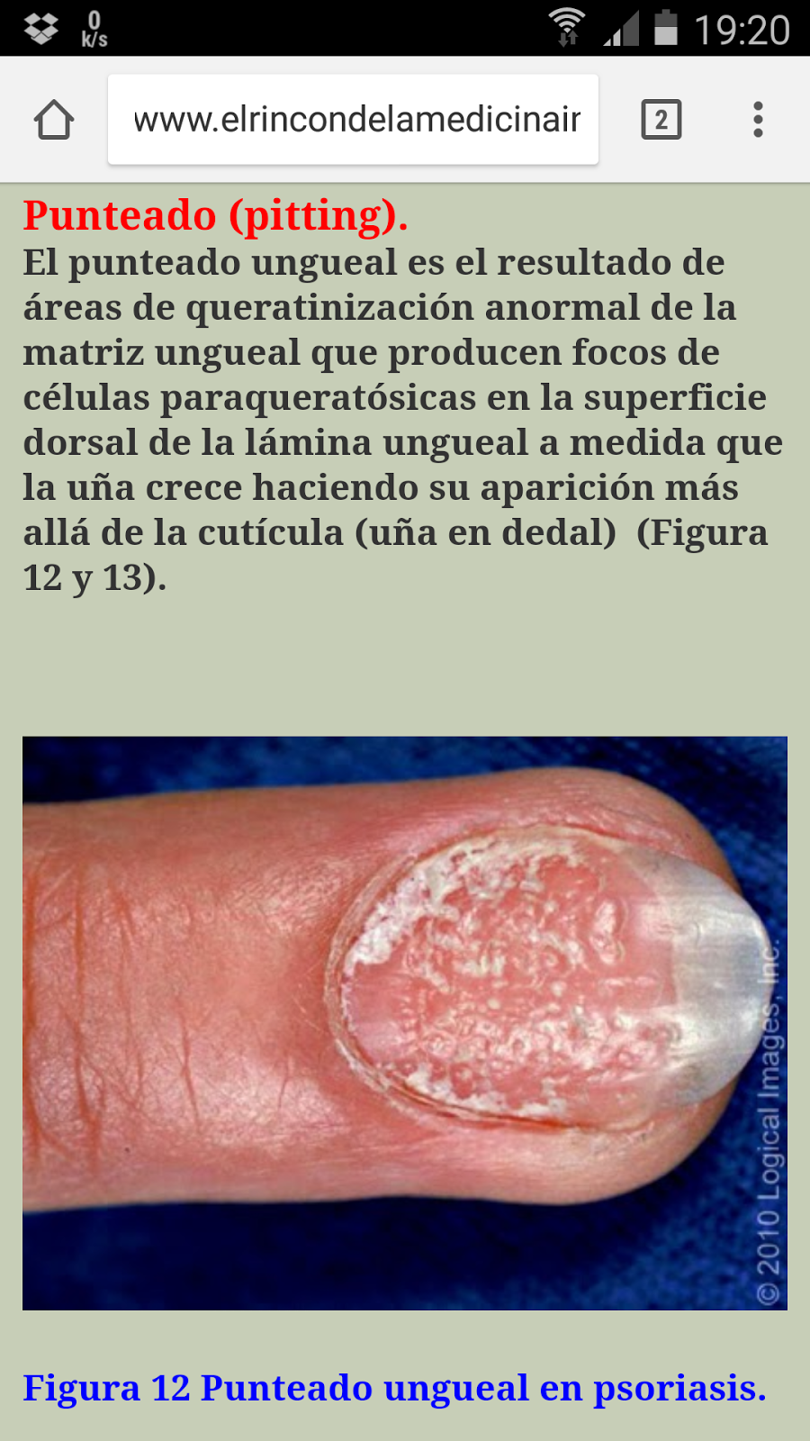 FMC BORMUJOS: PIQUETEADO UNGUEAL: NO SIEMPRE ES PSORIASIS