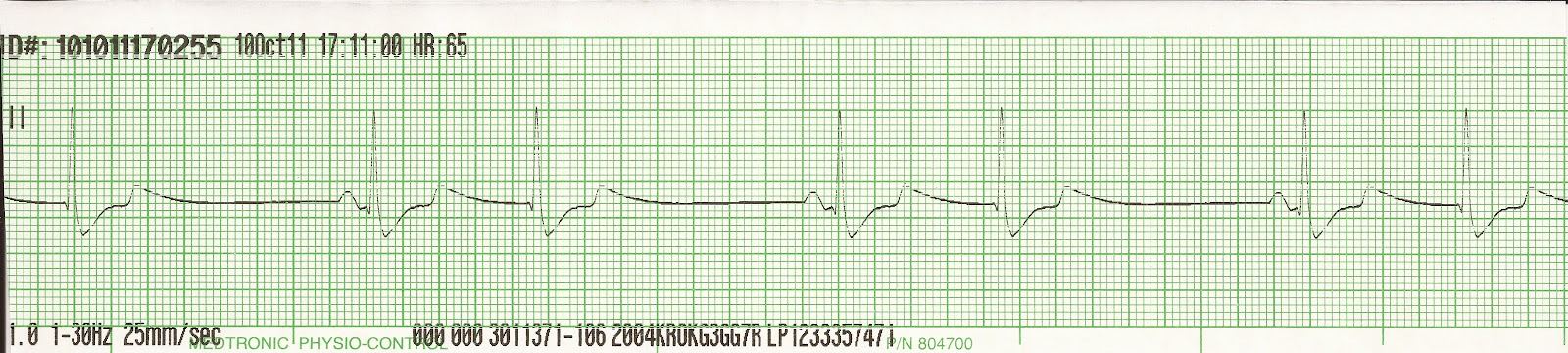 EKG Rhythm Strip Quiz 19