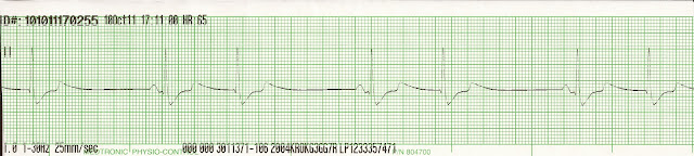 EKG Rhythm Strip Quiz 19