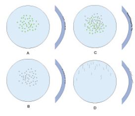 Ophthalmology | Ophthalmologist: NON-ULCERATIVE SUPERFICIAL KERATITIS