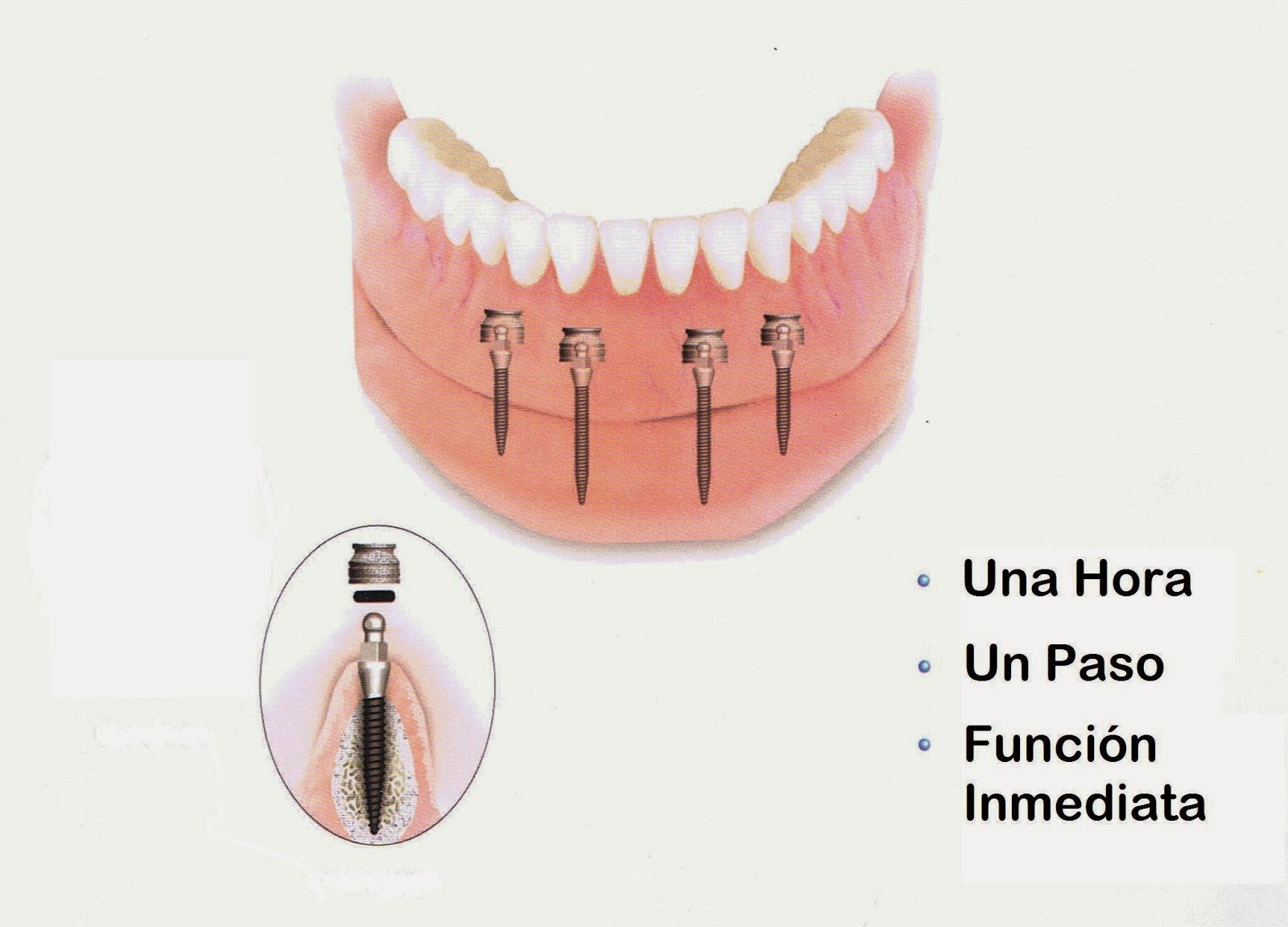 TKS. Centro de Odontología Avanzada: FIJACIÓN DE LAS PRÓTESIS DENTALES ...