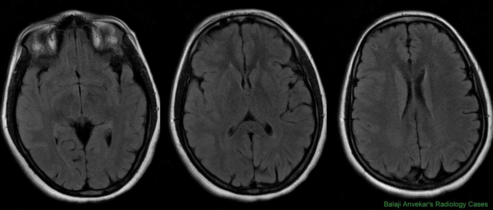 Dr Balaji Anvekar FRCR: Insular ribbon sign in Acute Ischemia