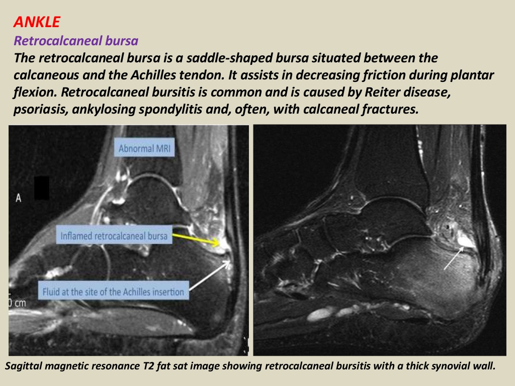 MRI Musculo-Skeletal Section: Bursa of ankle joint.