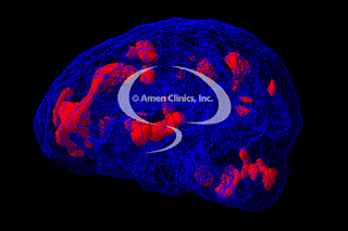 Dyslexia and Irlen Syndrome: Irlen Syndrome - Dyslexia and brain scans