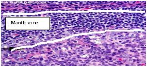 Pathology Cases: LN review