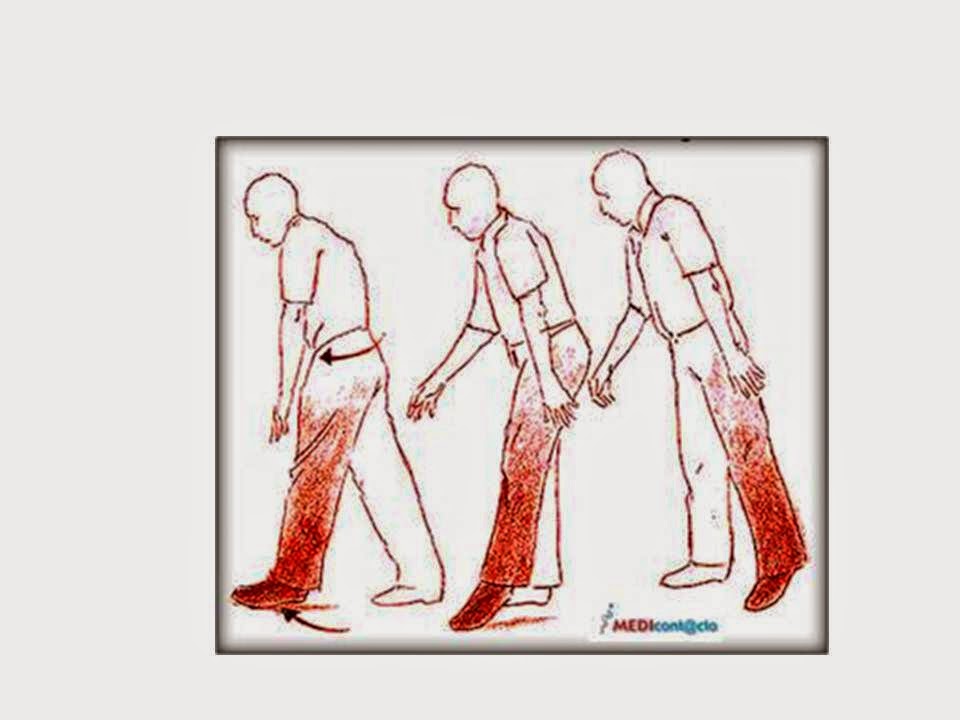 La Marcha Humana: Marchas Patológicas