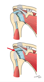 Shoulder Arthritis / Joint Replacement : Rotator interval closure - an ...
