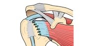 Shoulder Arthritis / Joint Replacement : Rotator interval closure - an ...