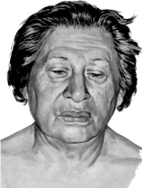 Semiología Quirúrgica Dra. Leroux R.: Facies