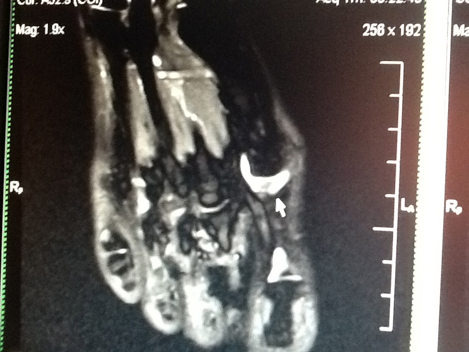 Foot and Ankle Problems By Dr. Richard Blake: Sesamoid Injury: MRI ...