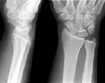 Bone Section: Normal Hand and Wrist Anatomy