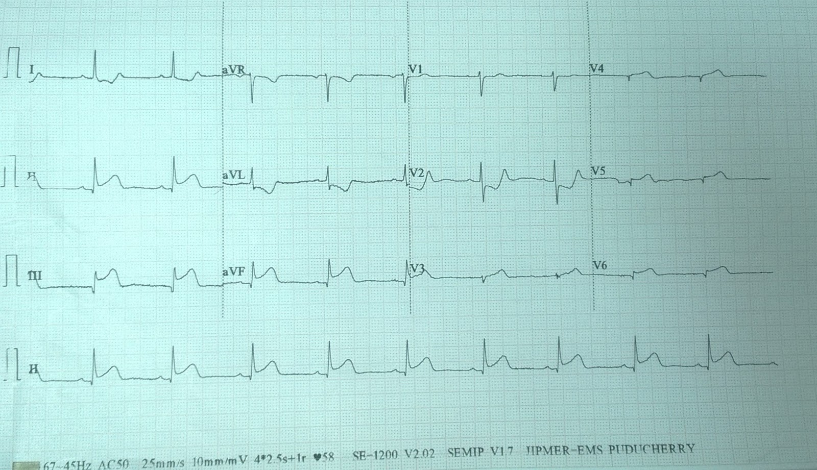 Cardiology window: Inferior wall with posterior wall with right wall ...