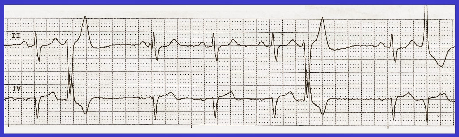 Practice EKG Rhythm Strips 223