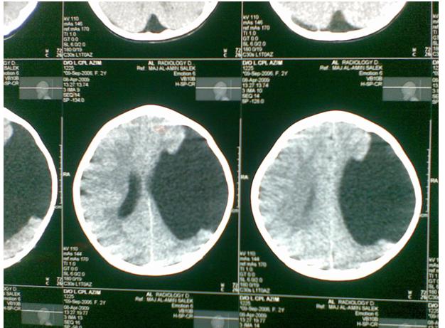 Convulsion and Unani Management