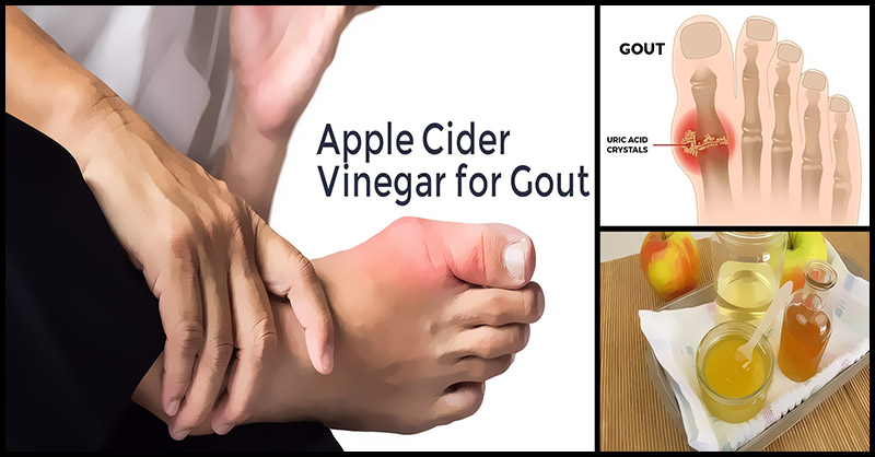Help Treat Gout With Apple Cider Vinegar | Dr Farrah MD