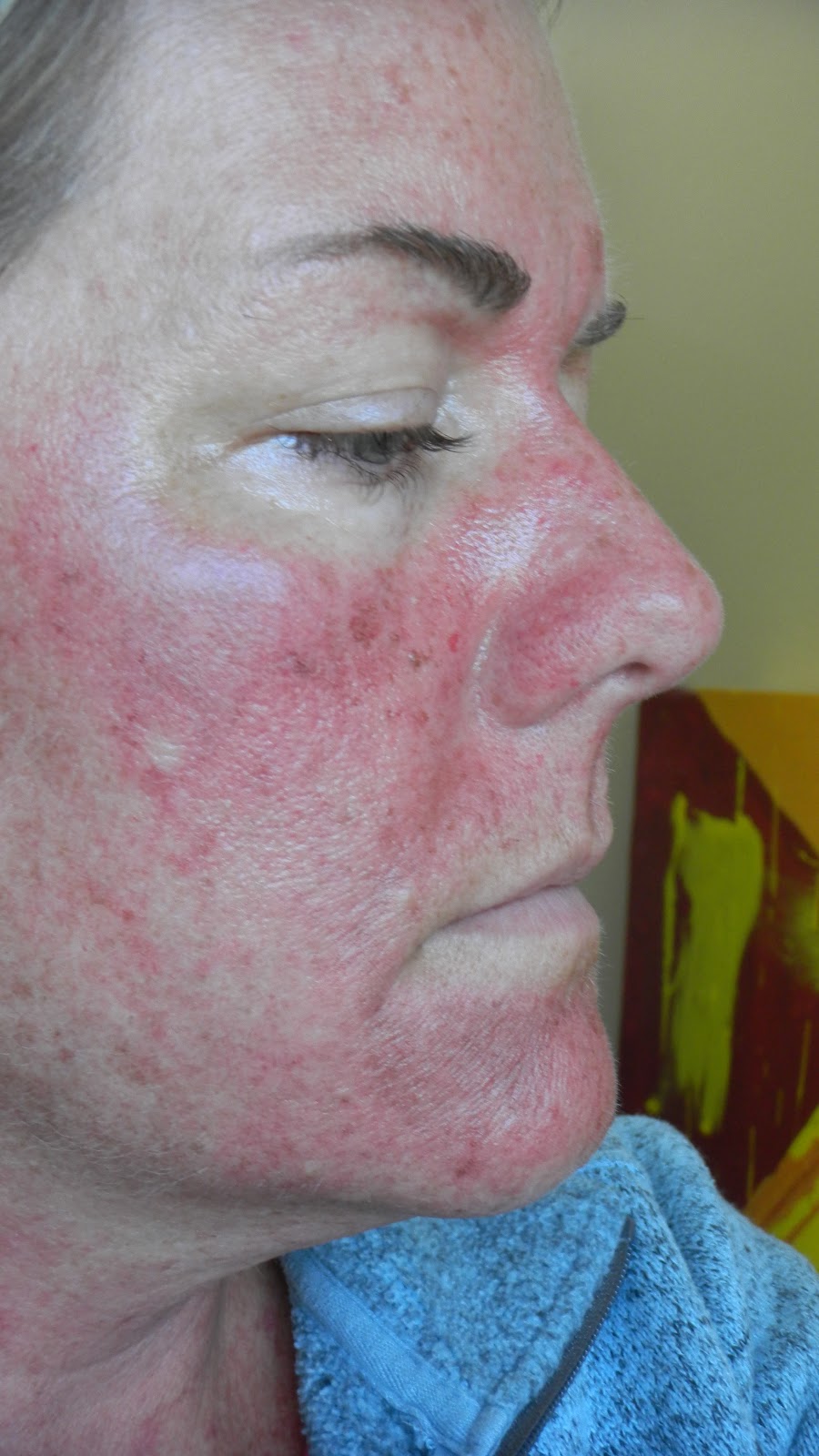 Efudex and Me 2013: Efudex Day Twelve