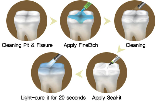 FISSURE SEALING-Introduction, Definition, Clinical technique ...