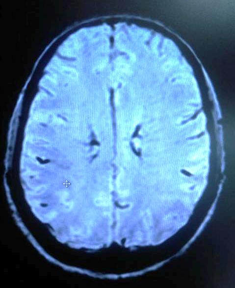 Brain death For Radiologist - Sumer's Radiology Blog