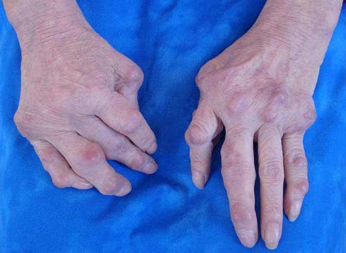 VIRTUAL GRAND ROUNDS IN DERMATOLOGY 2.0: A Complex Patient