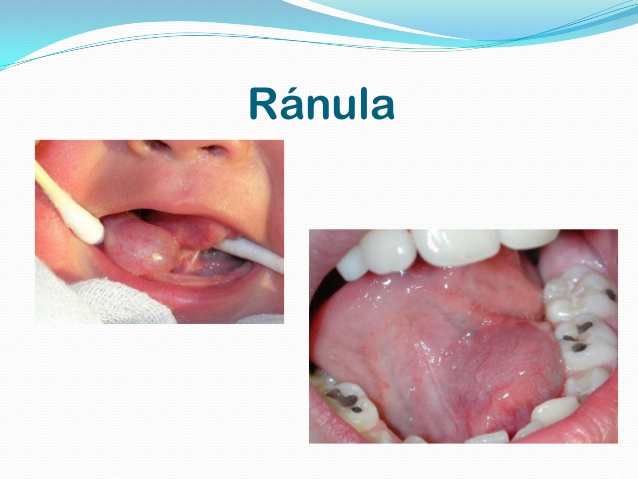 Ranula sublingual / piso de la boca / conferencias pediatricas ...