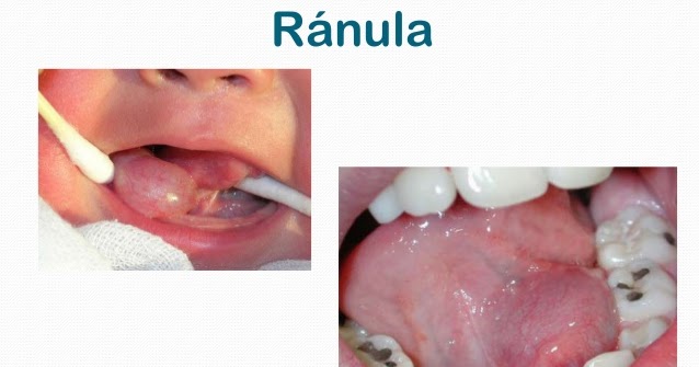Ranula sublingual / piso de la boca / conferencias pediatricas ...