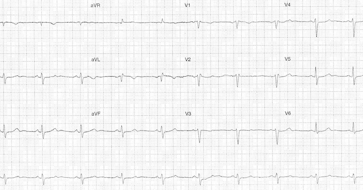 ECG of the Week: ECG of the Week - 15th October 2018 - Interpretation