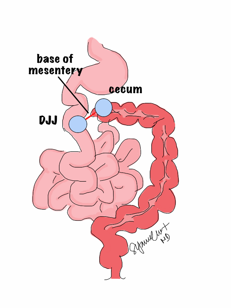 Pediatric Surgery Zone: How can laparoscopy help evaluate patients with ...