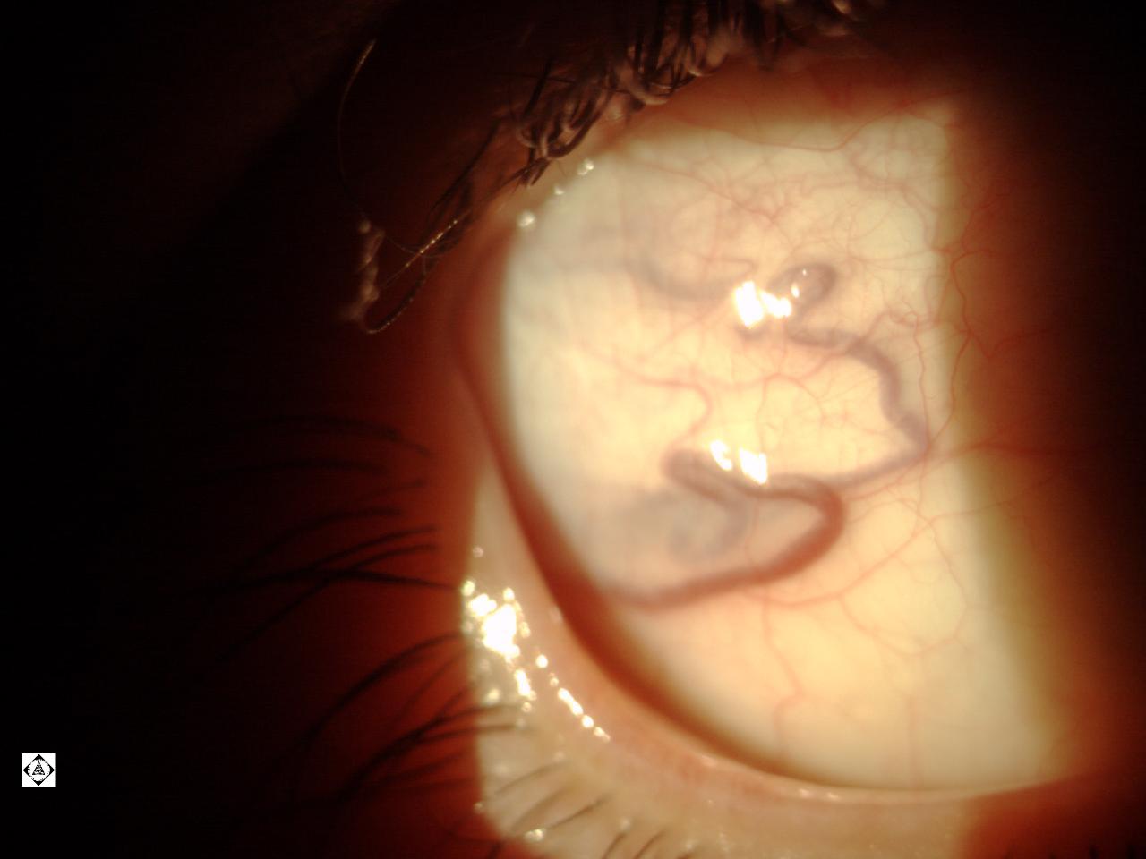 Dilated Conjunctival Vessels