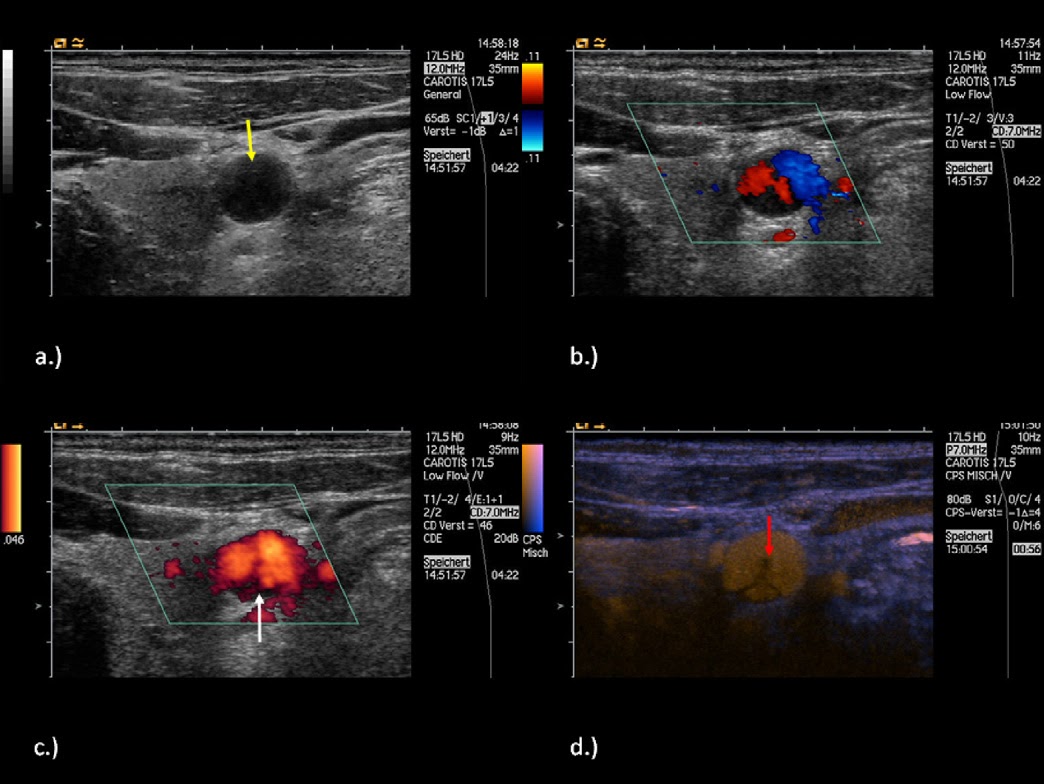 The Pump and the Tubes: Carotid Dissection on Ultrasound