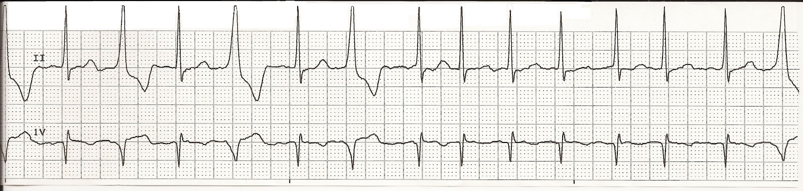 Bigeminal Rhythm Ekg