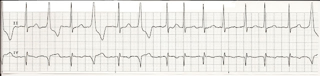 EKG Rhythm Strip Quiz 4